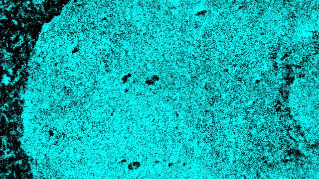 New AI tool classifies brain tumors using images of tumor slides ... New AI tool classifies brain tumors using images of tumor slides ...